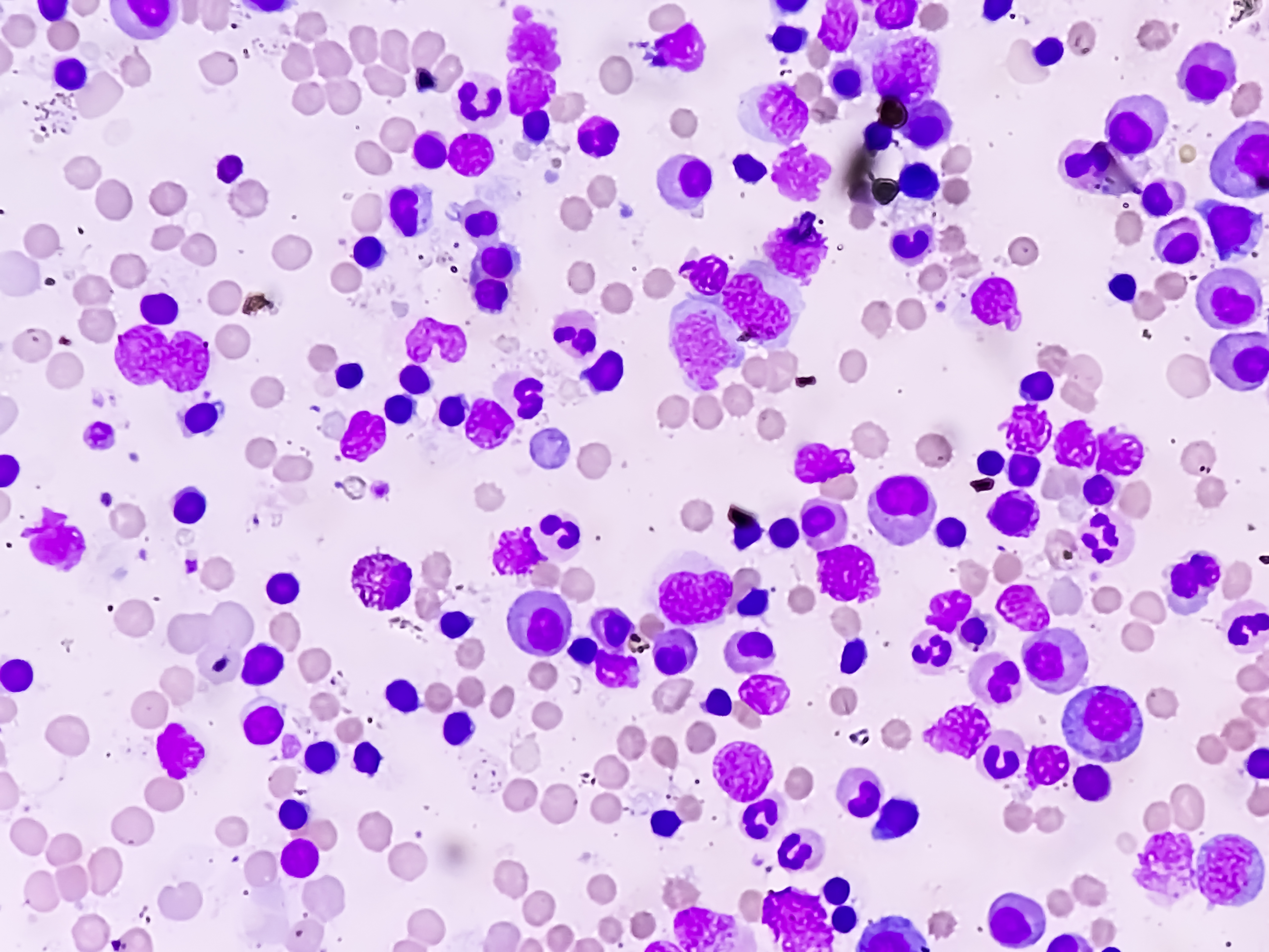 Simplifying Mds Testing With Next Generation Sequencing Ngs